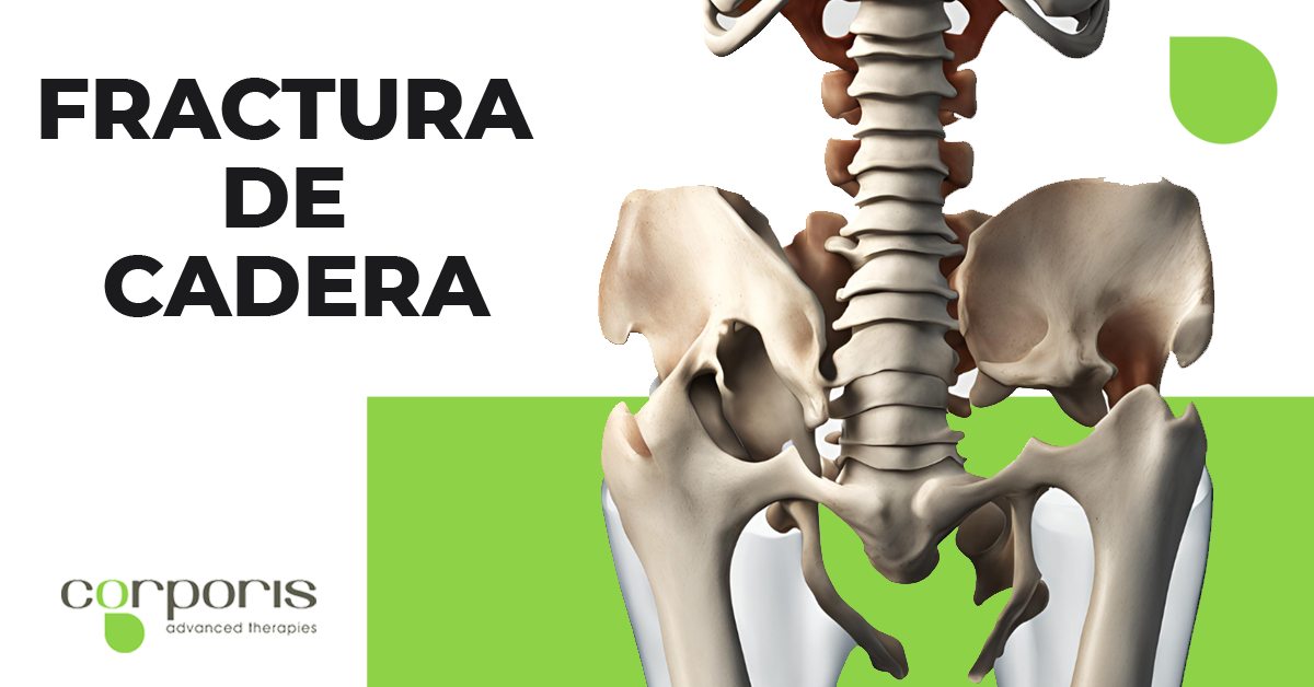 FRACTURA DE CADERA: DESDE LA LESIÓN HASTA LA REHABILITACIÓN - Corporis ...